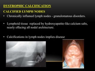 Calcification Of Lymph Nodes