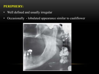 Calcification Of Lymph Nodes