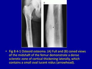 4 solitary or multiple osteosclerotic bone lesions | PPT