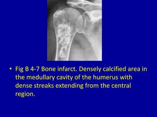 4 solitary or multiple osteosclerotic bone lesions | PPT