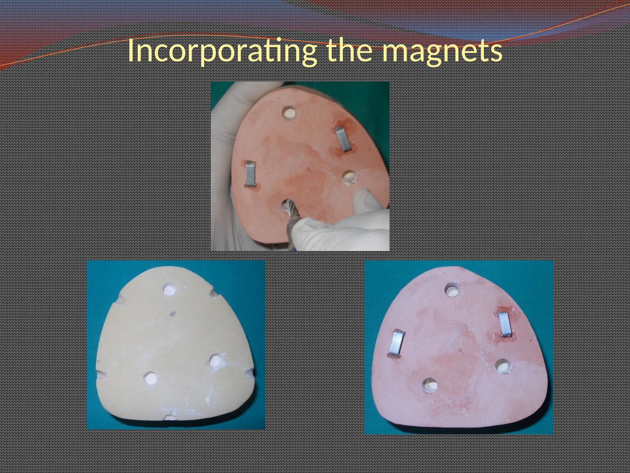 4 Split cast. complete denture lab work. | PPTX