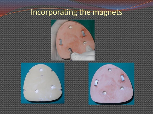 4 Split cast. complete denture lab work. | PPTX
