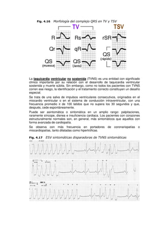 Taquiarritmias regulares QRS ancho | PDF