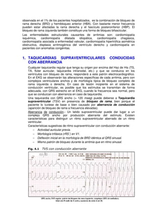 Taquiarritmias regulares QRS ancho | PDF