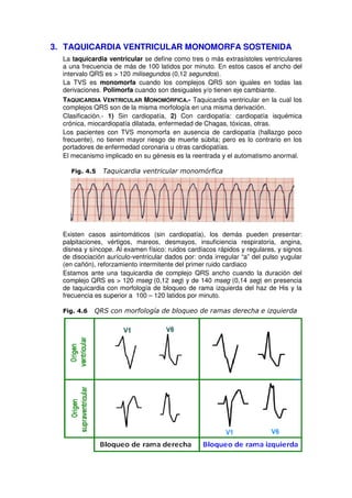 Taquiarritmias regulares QRS ancho | PDF