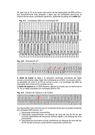 Taquiarritmias regulares QRS ancho | PDF
