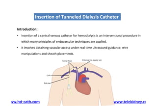 Tunneled HD Catheters Dr. Zaghloul Gouda | PPT