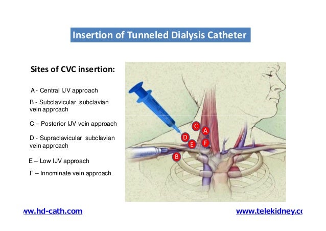 Tunneled HD Catheters Dr. Zaghloul Gouda
