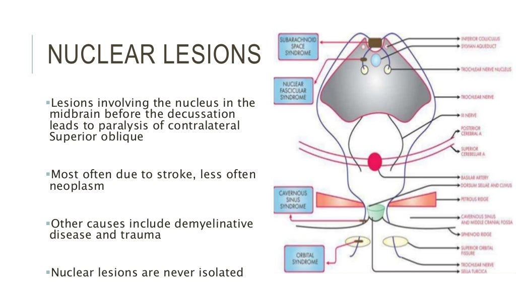 Trochlear Nerve
