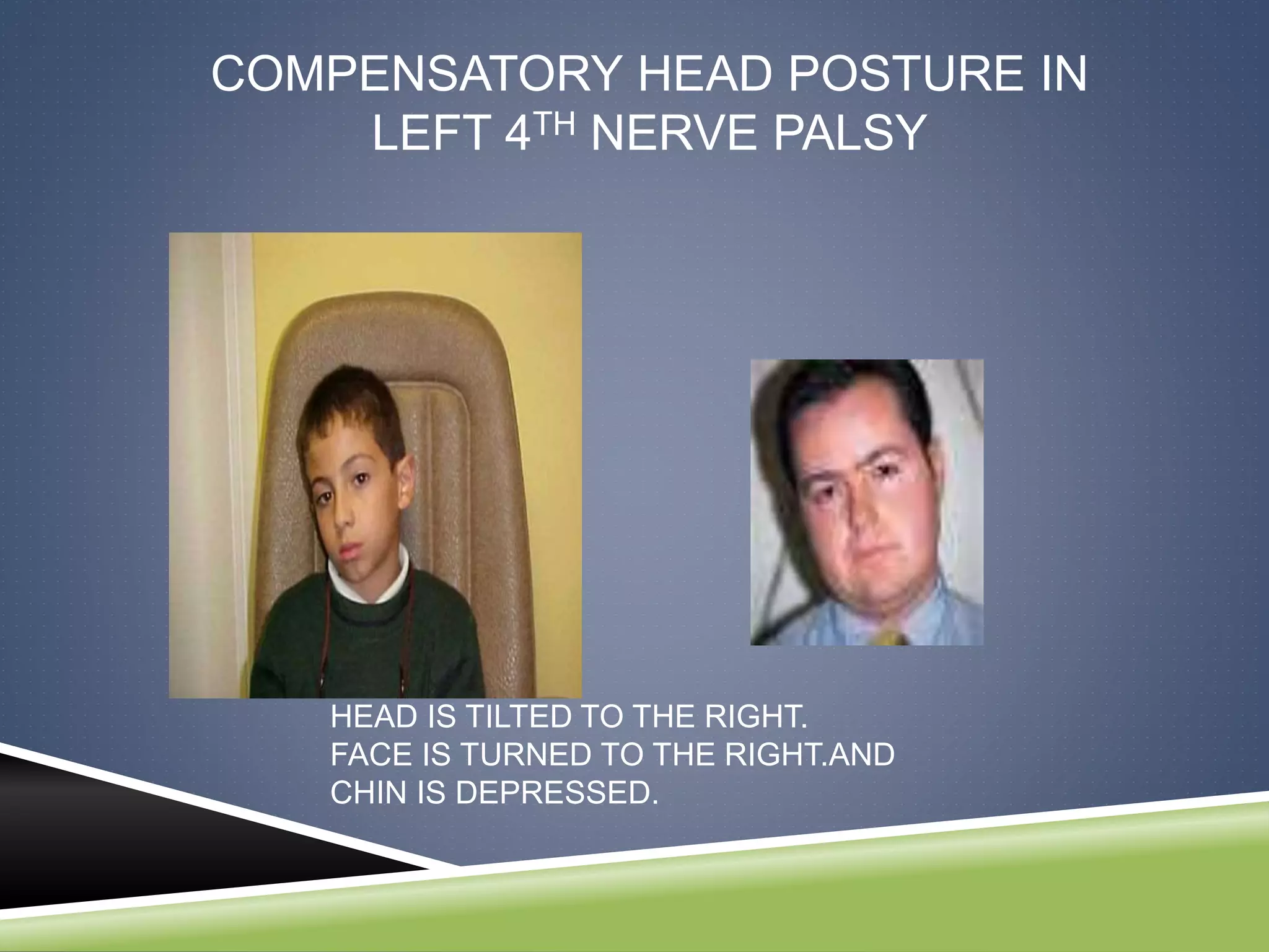 4th nerve palsy | PPTX