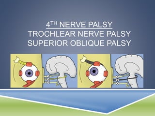 Trochlear Nerve Palsy