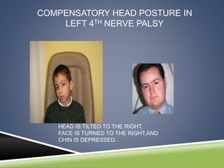 4th nerve palsy | PPTX