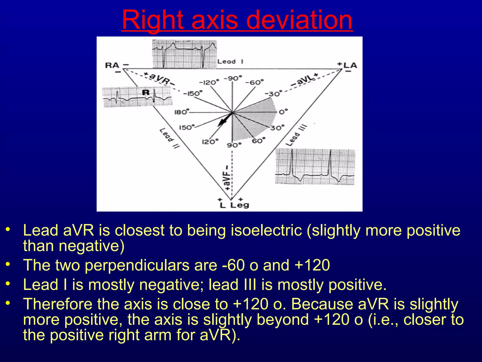 4th part ECG Basics: cardiac axis Dr Salah Mabrouk Khallaf | PPT