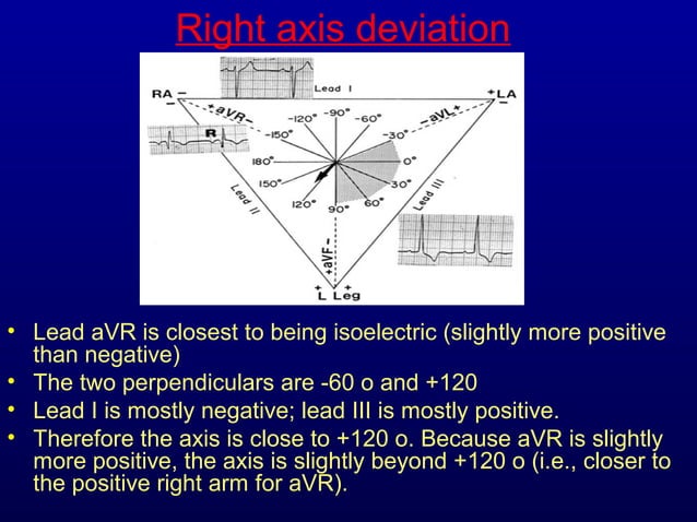 4th part ECG Basics: cardiac axis Dr Salah Mabrouk Khallaf | PPT ...