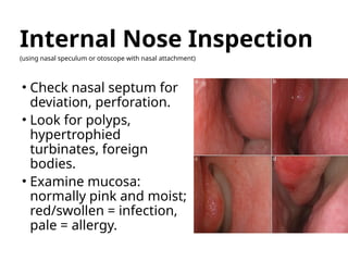 Nursing Management of Patients with Disorders of Ear, Nose, and Throat ...