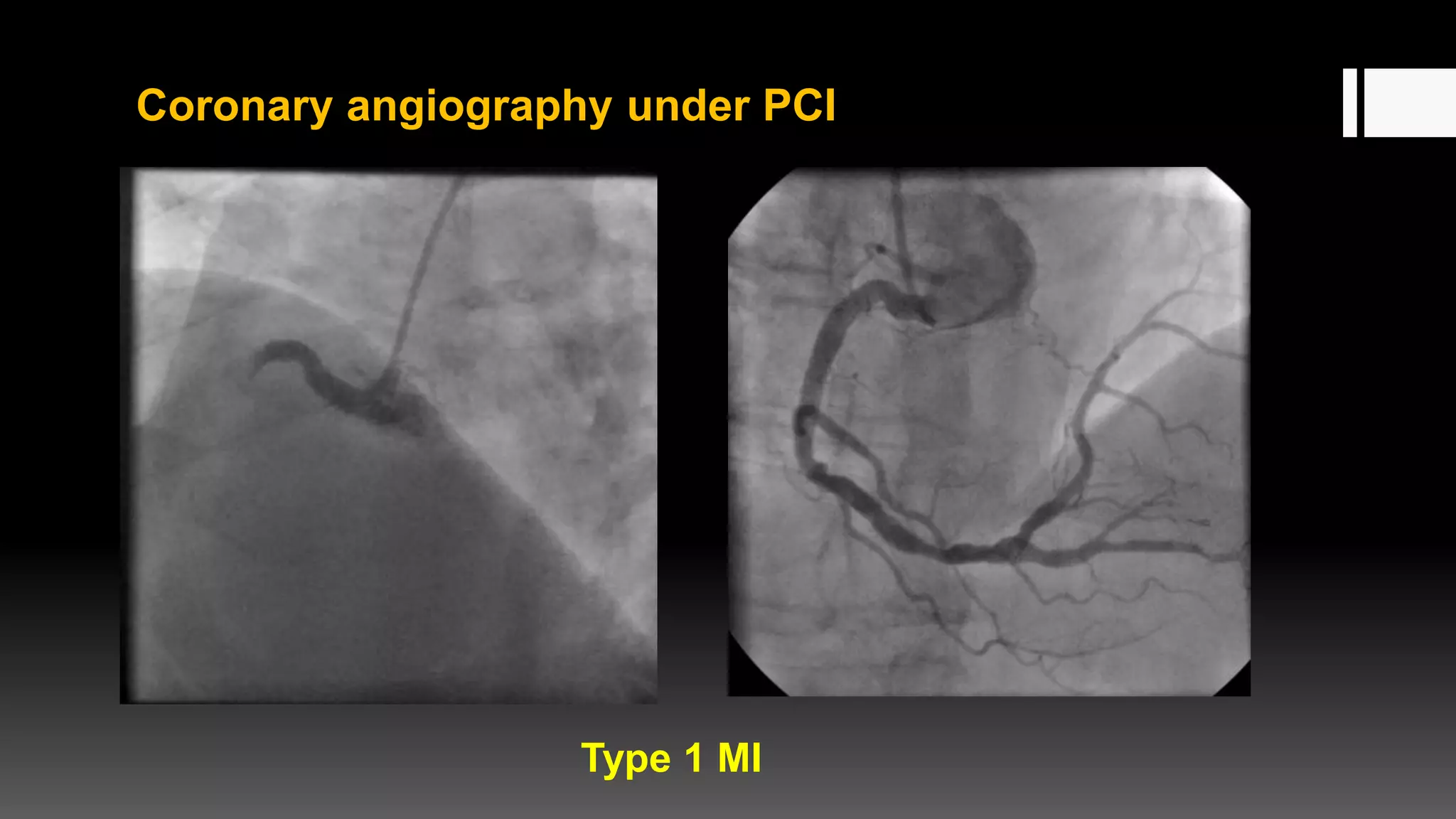 Universal Definition of Myocardial Infarct | PPTX