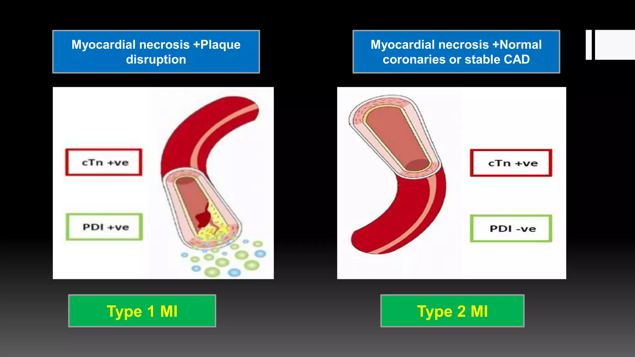 Universal Definition of Myocardial Infarct | PPTX