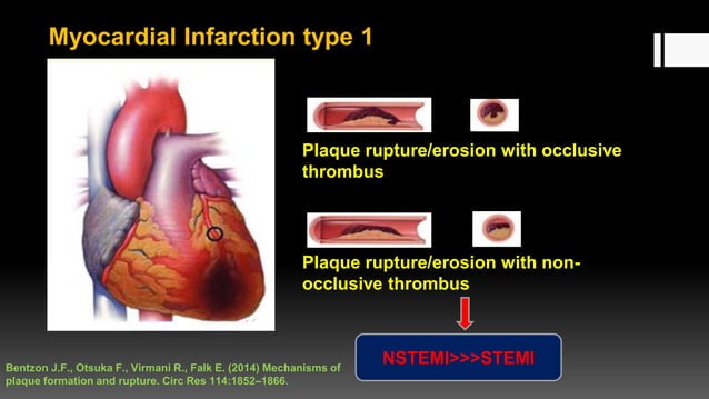 Universal Definition of Myocardial Infarct | PPTX