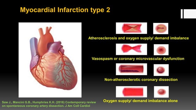 Universal Definition of Myocardial Infarct | PPTX