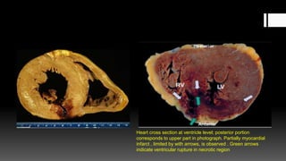 Universal Definition of Myocardial Infarct | PPTX