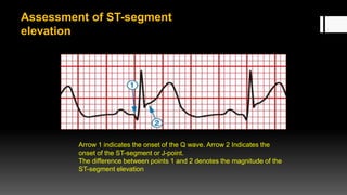 Universal Definition of Myocardial Infarct | PPTX