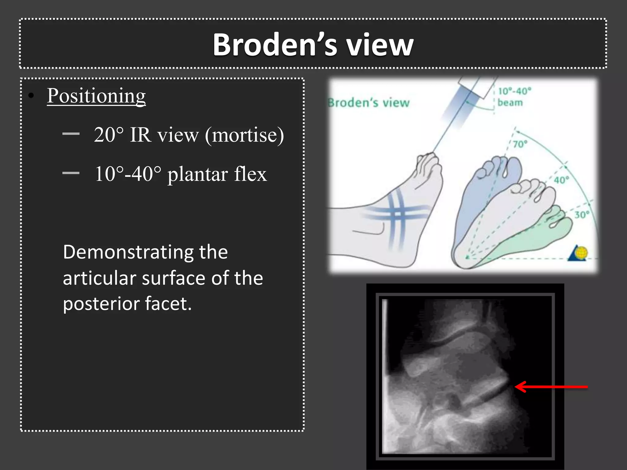 Calcaneal fractures | PPTX