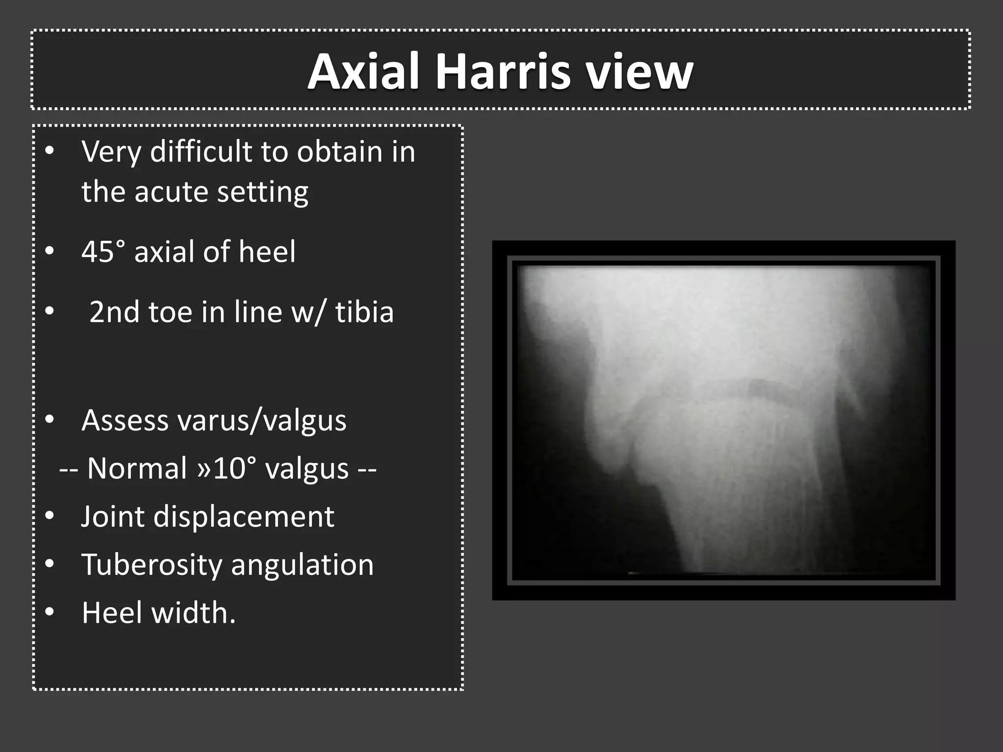 Calcaneal fractures | PPTX