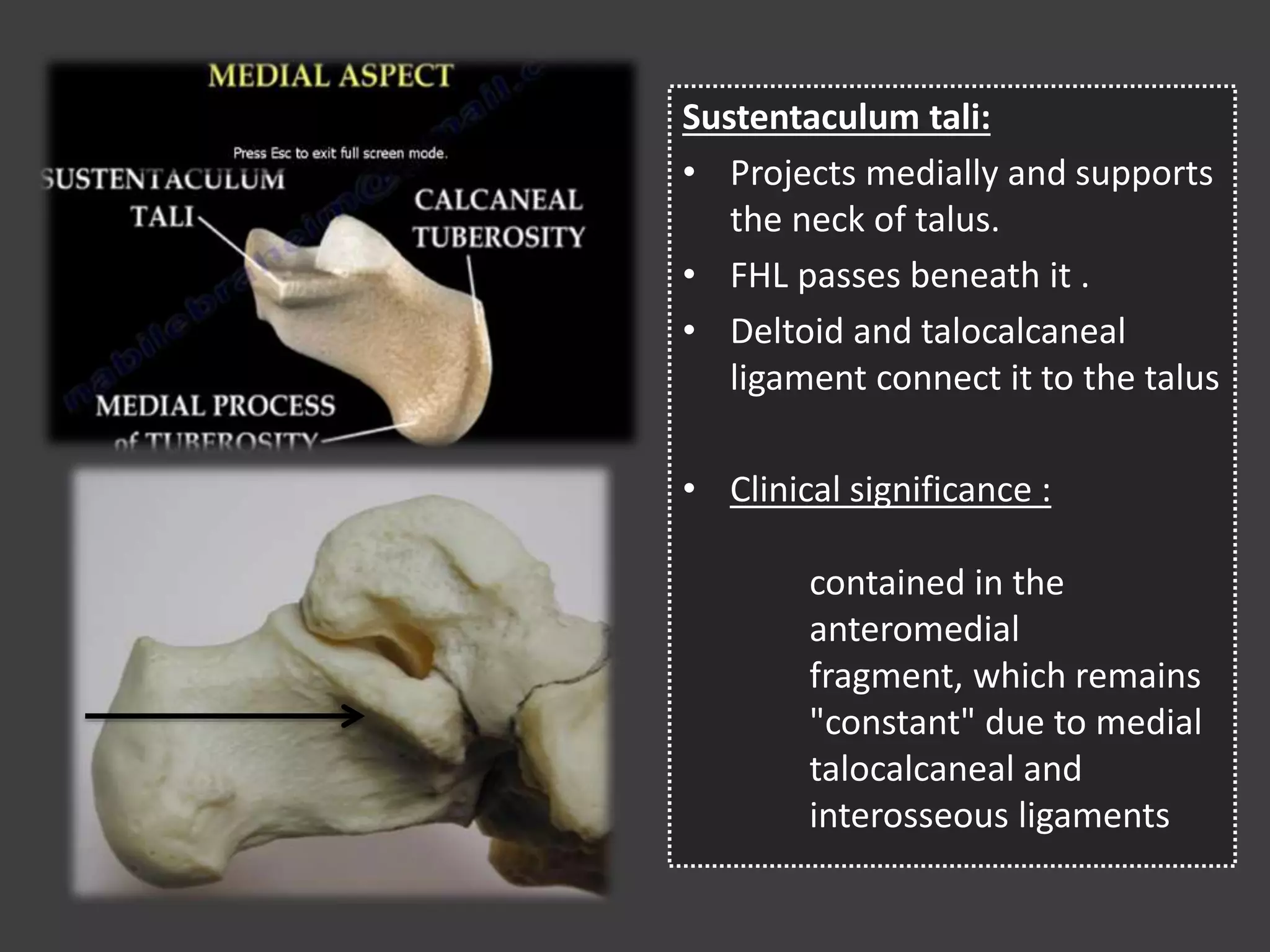 Calcaneal fractures | PPTX