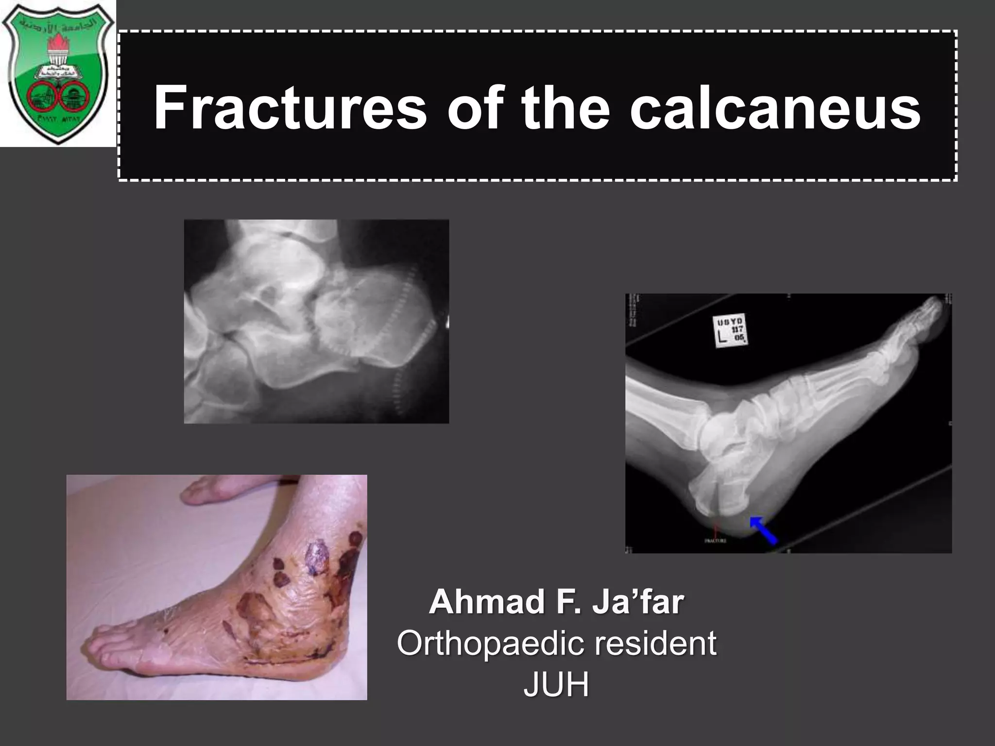 Calcaneal fractures | PPT