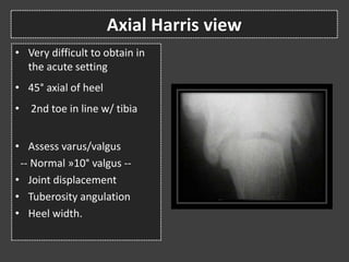 Calcaneal fractures | PPT