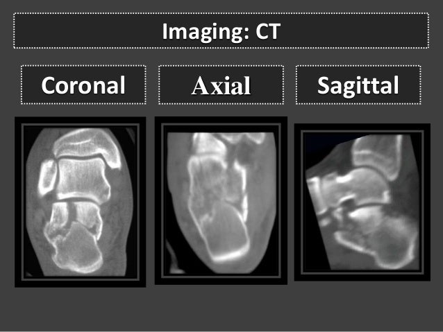 Calcaneal fractures