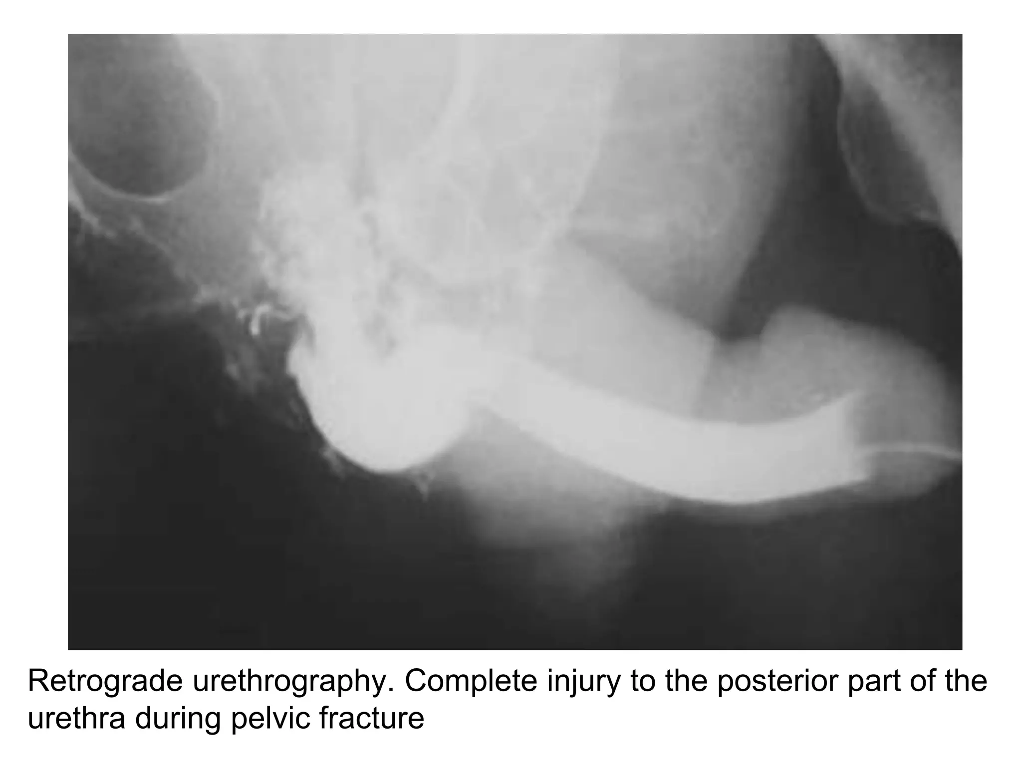 urology trauma (1).pptx