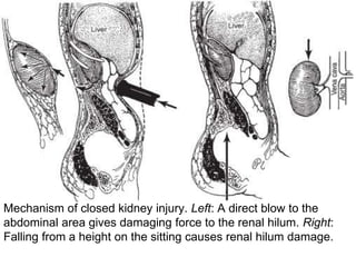 urology trauma (1).pptx