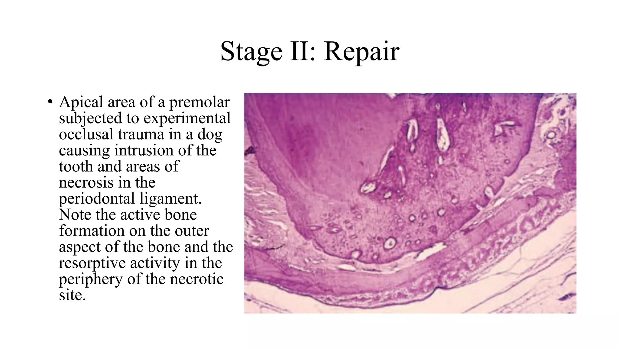 Trauma from Occlusion | PDF