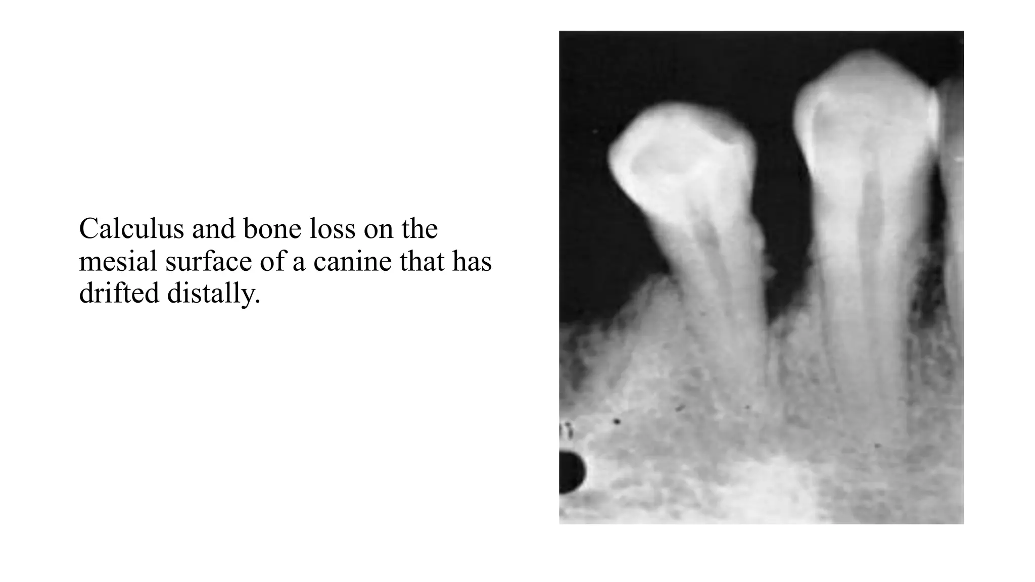 Trauma from Occlusion | PDF