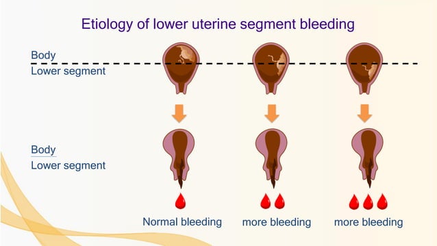 Postpartum Hemorrhage / 4T's Plus Model / Lower Uterine Segment ...