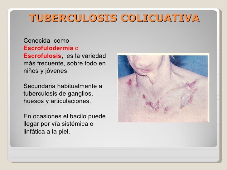 4 tuberculosis.sifilis, lepra