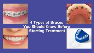 4 Types of Braces You Should Know Before Starting Treatment | PPTX