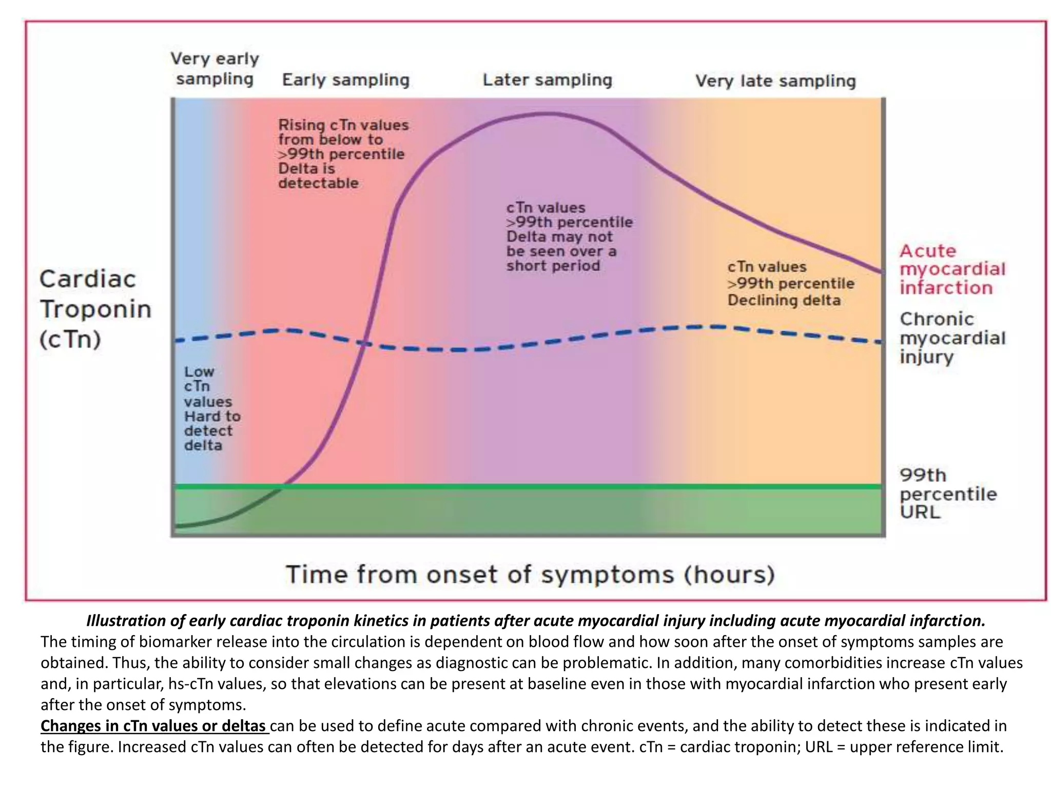 Fourth Universal Definition Of Myocardial Infarction (2018) | PPTX