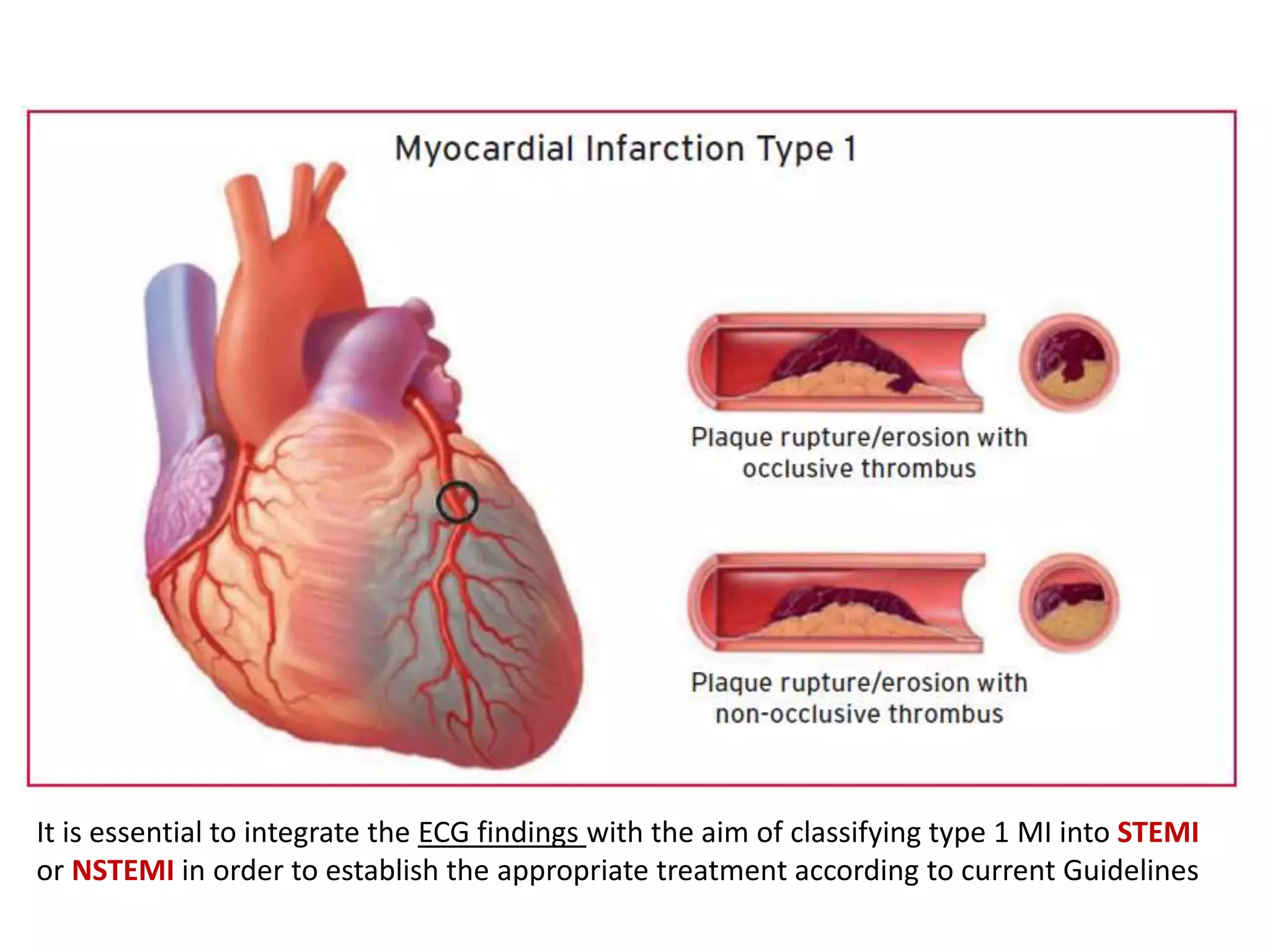 Fourth Universal Definition Of Myocardial Infarction (2018) | PPTX