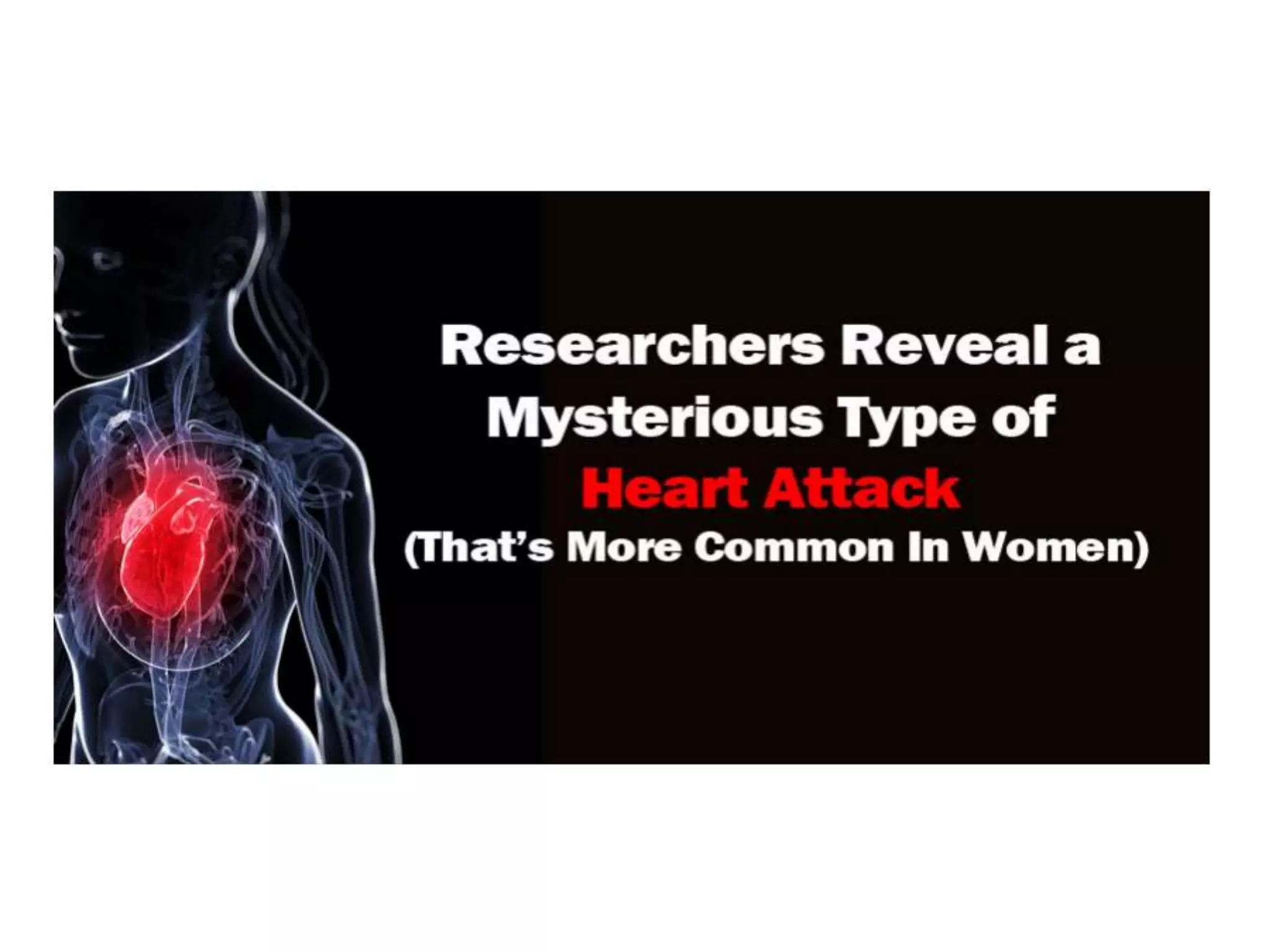 Fourth Universal Definition Of Myocardial Infarction (2018) | PPTX