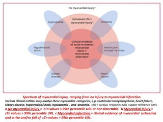 Fourth Universal Definition Of Myocardial Infarction (2018) | PPTX