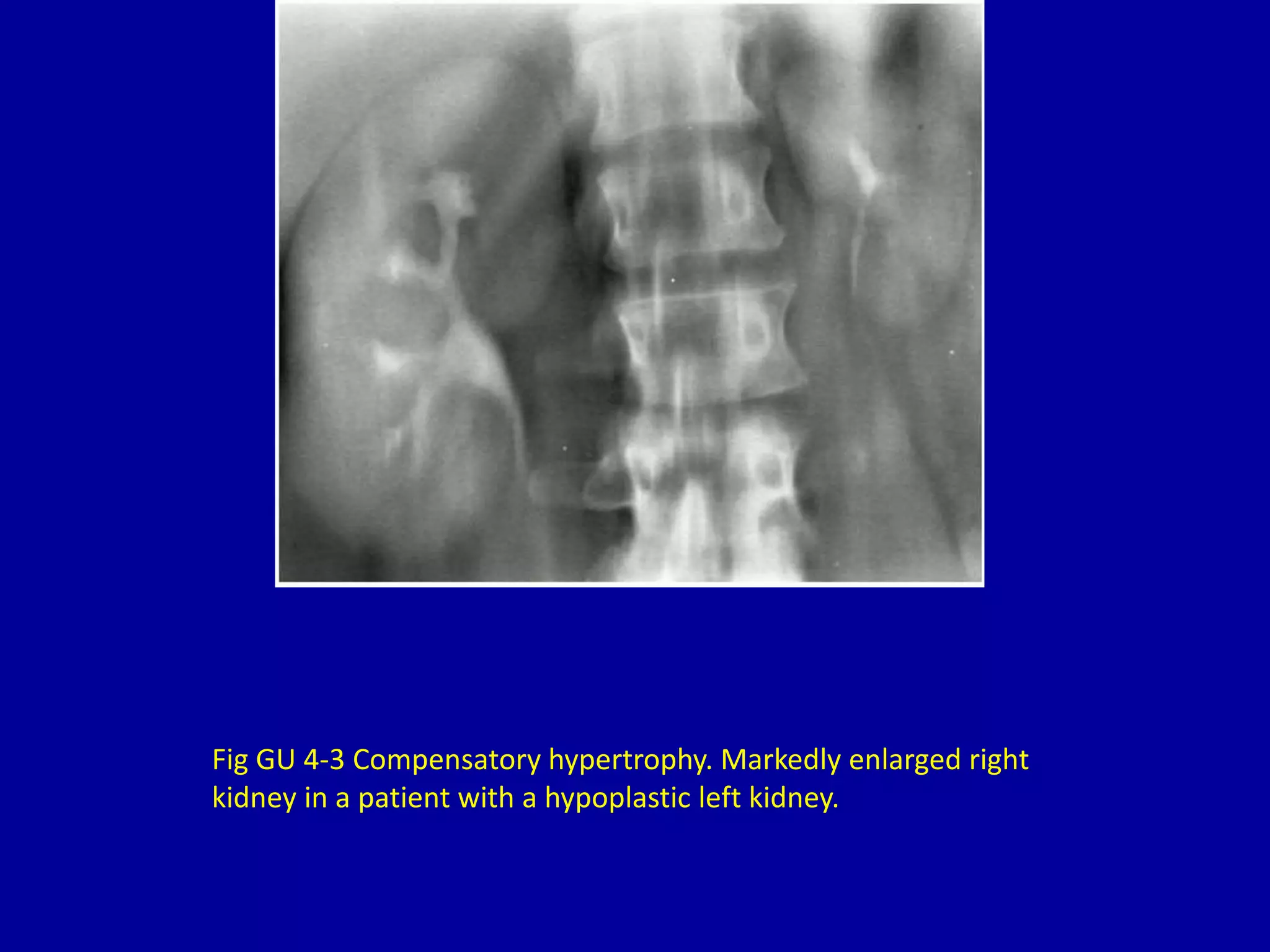 4 unilateral large, smooth kidney | PPTX