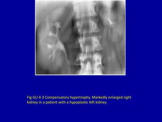 4 unilateral large, smooth kidney | PPTX