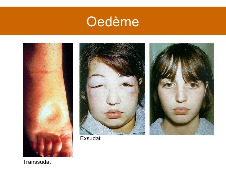 Cours 4 - Pathologie vasculaire