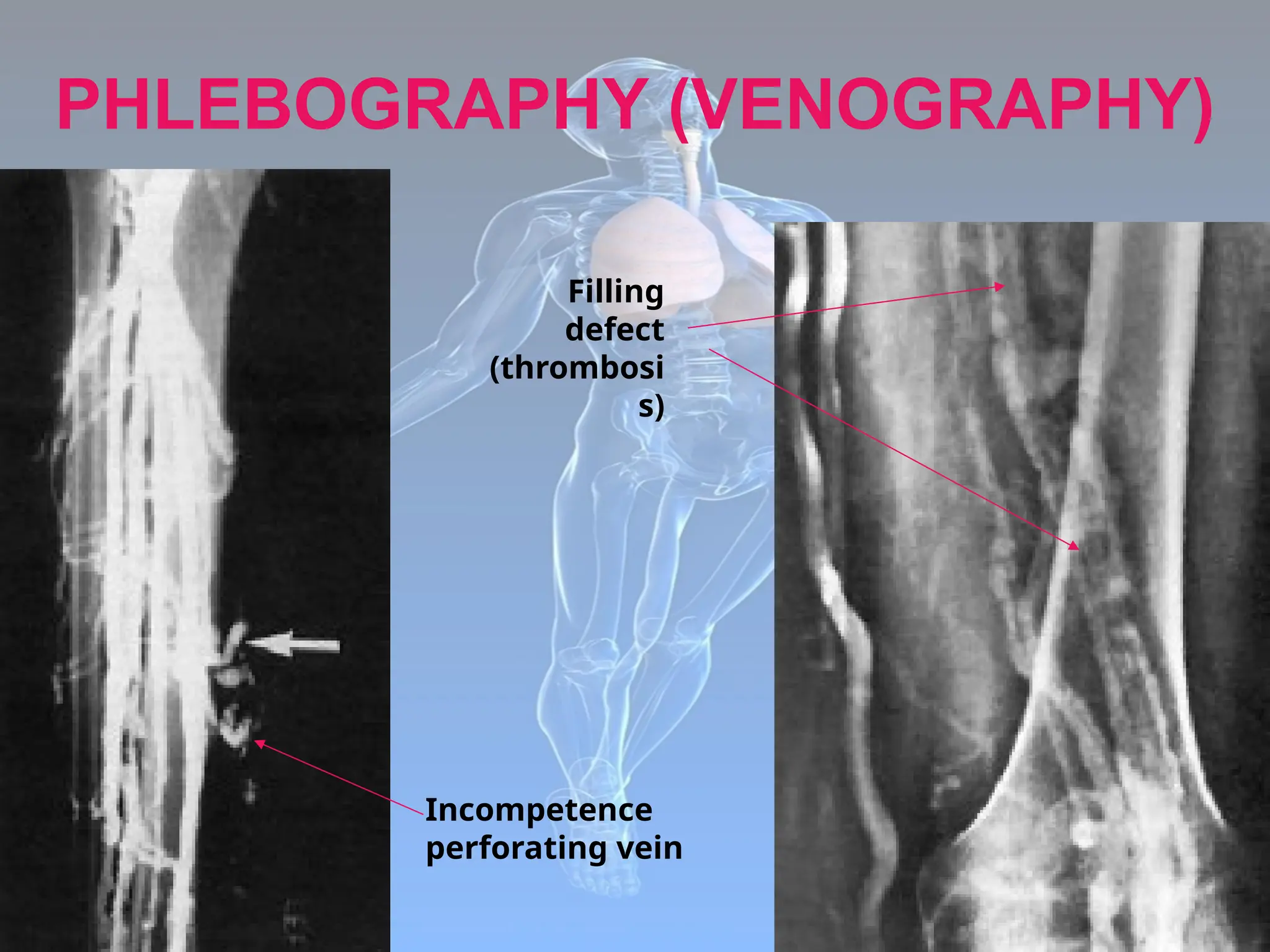 Vascular radiology blood vessels x ray CT MRI .pptx