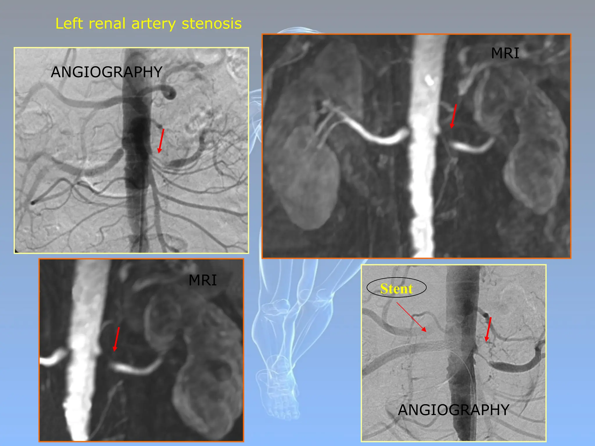 Vascular radiology blood vessels x ray CT MRI .pptx