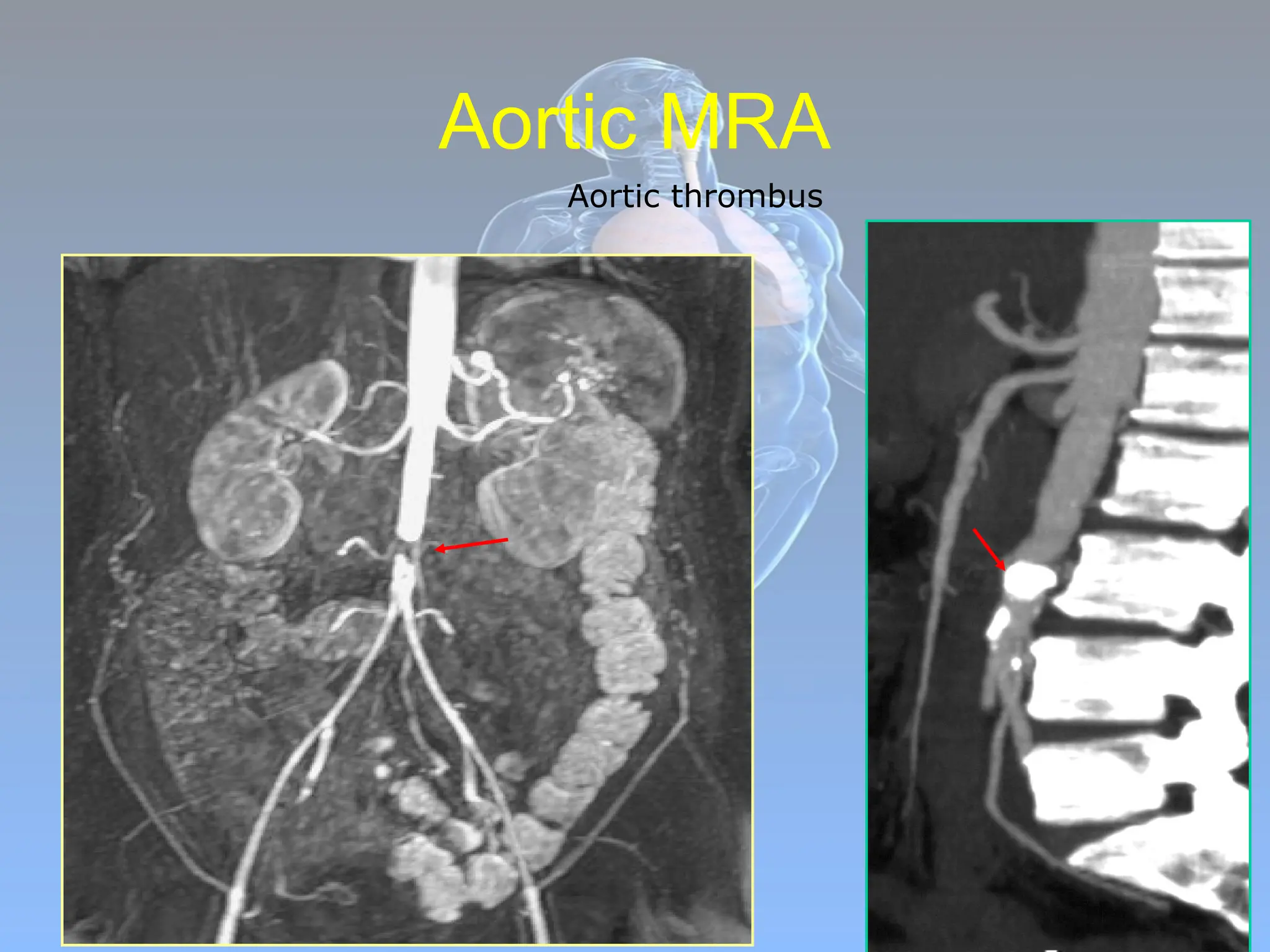 Vascular radiology blood vessels x ray CT MRI .pptx