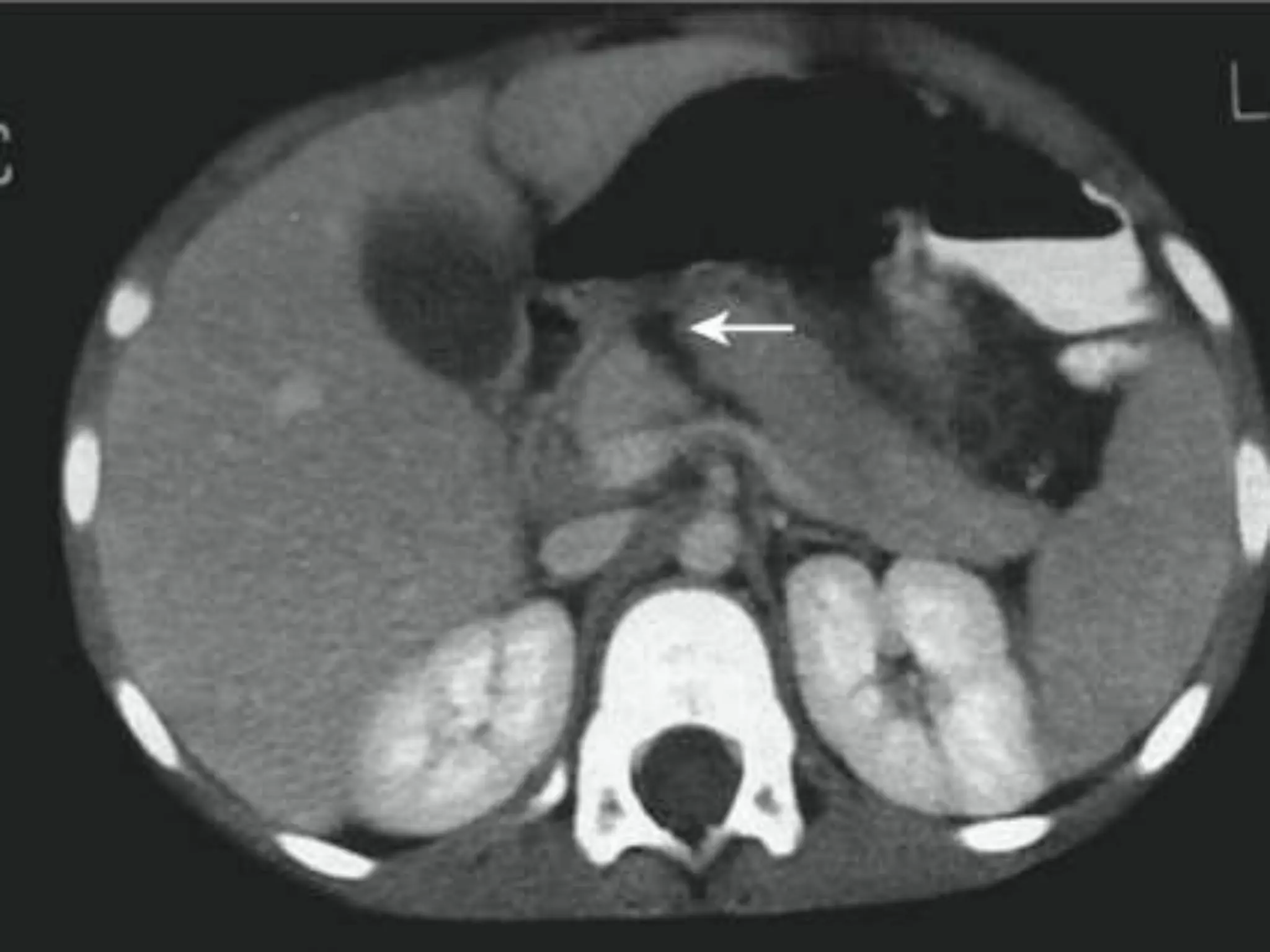 Pediatric abdominal trauma | PPTX