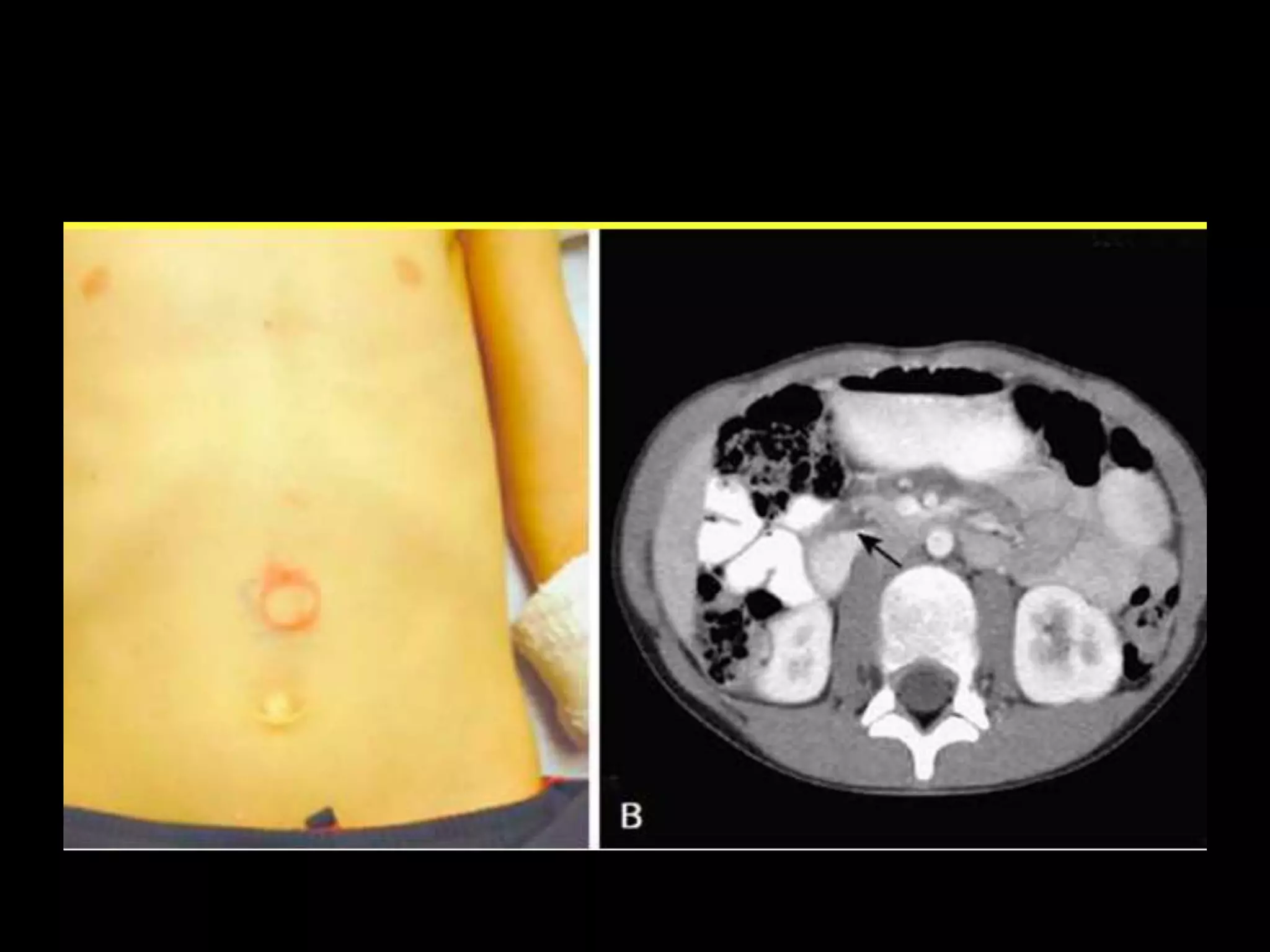 Pediatric abdominal trauma | PPTX